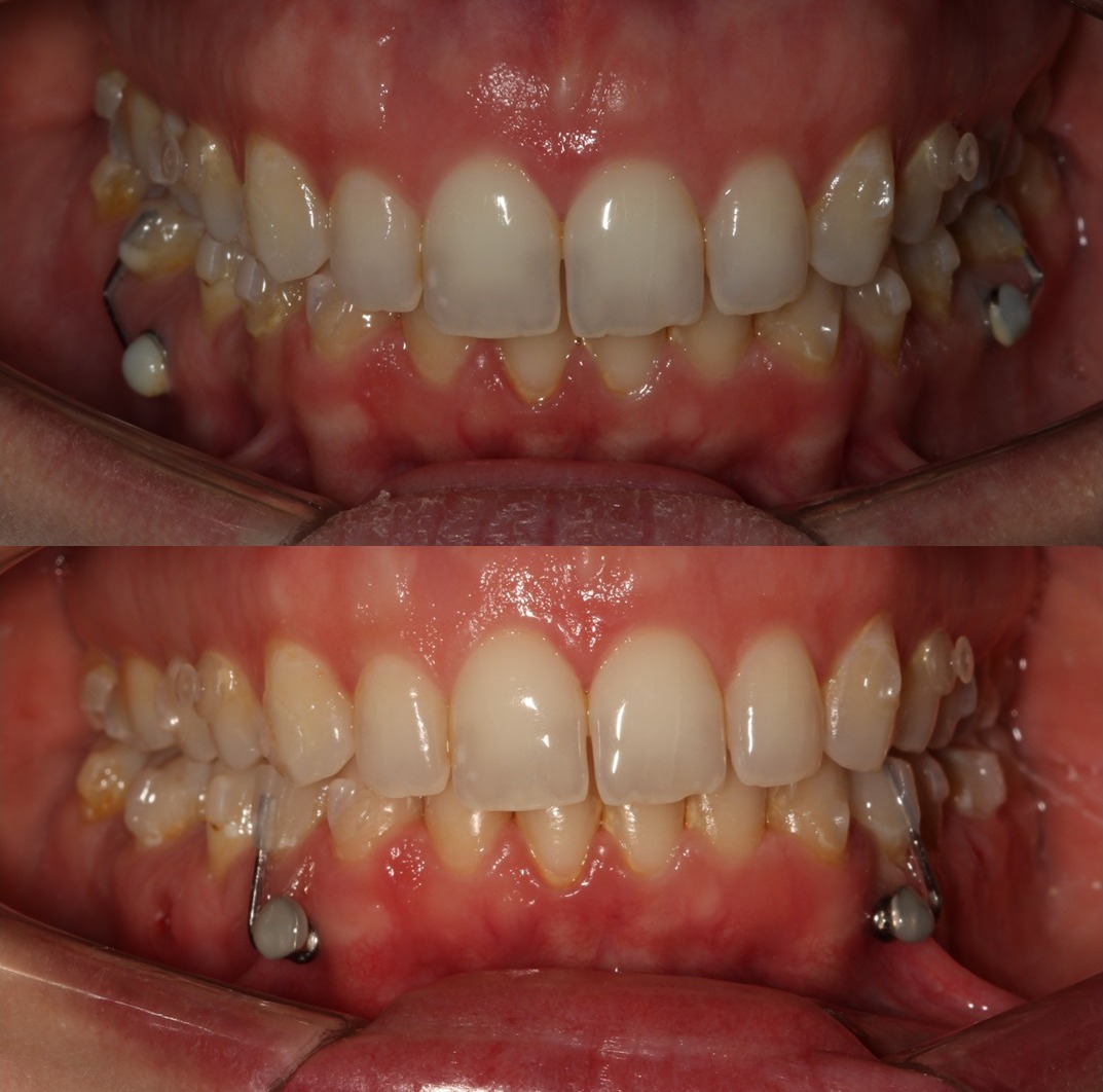 [MINI-IMPLANTES] Aplicação Clínica e Biomecânica - Inscrição - Tudo ...