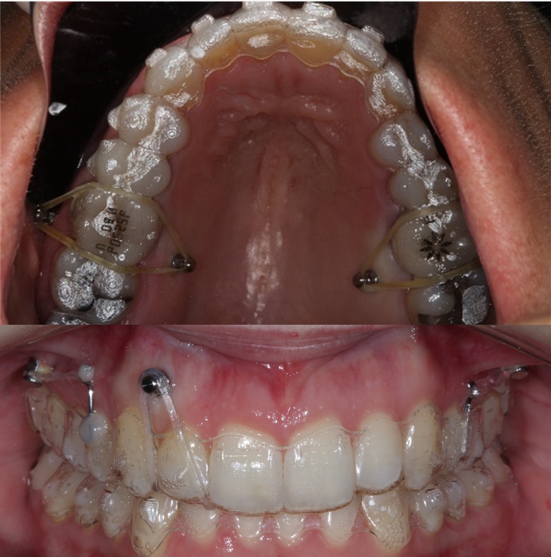 [MINI-IMPLANTES] Aplicação Clínica e Biomecânica - Inscrição - Tudo ...