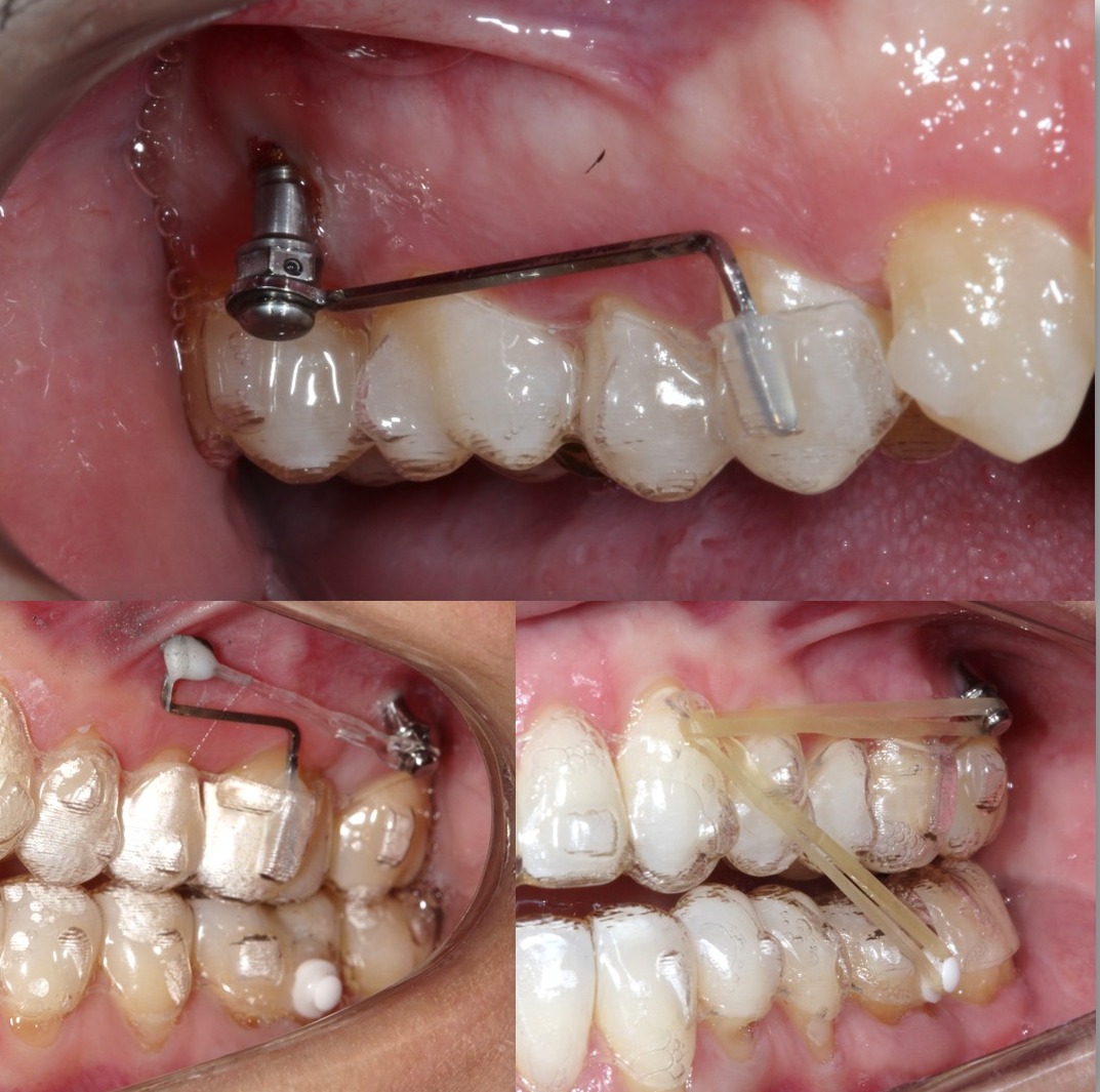 [MINI-IMPLANTES] Aplicação Clínica e Biomecânica - Inscrição - Tudo ...